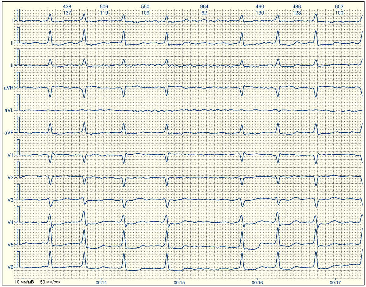Understanding the Importance of Electrocardiogram (ECG) Examinations f ...